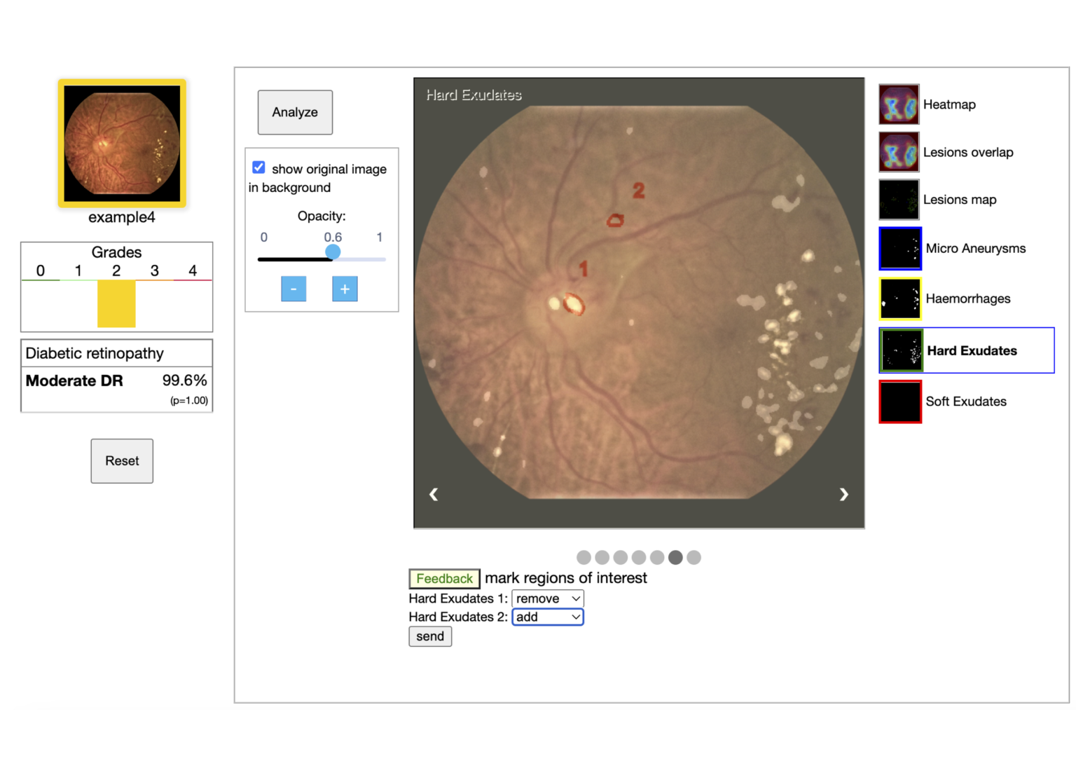 Interpretable and Interactive Disease Diagnosis Using Collaborative Learning of Segmentation and ...